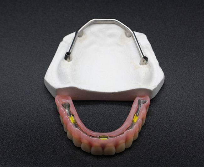 Implant Bar - China Dental Laboratory (CDL) Co., Ltd Implant Bar - China Dental Laboratory (CDL) Co., Ltd